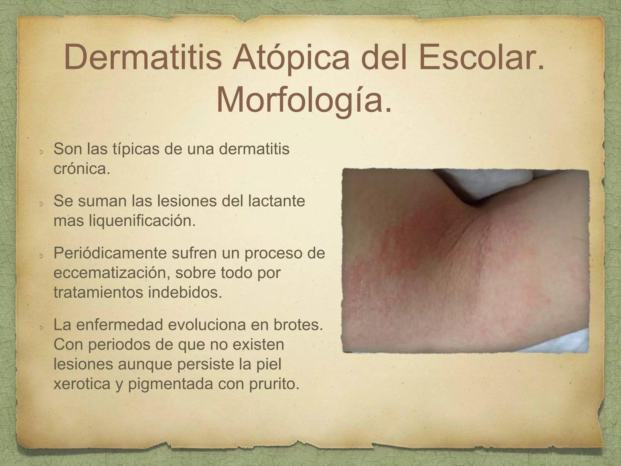 Dermatitis atópica. Dermatología. | PPT