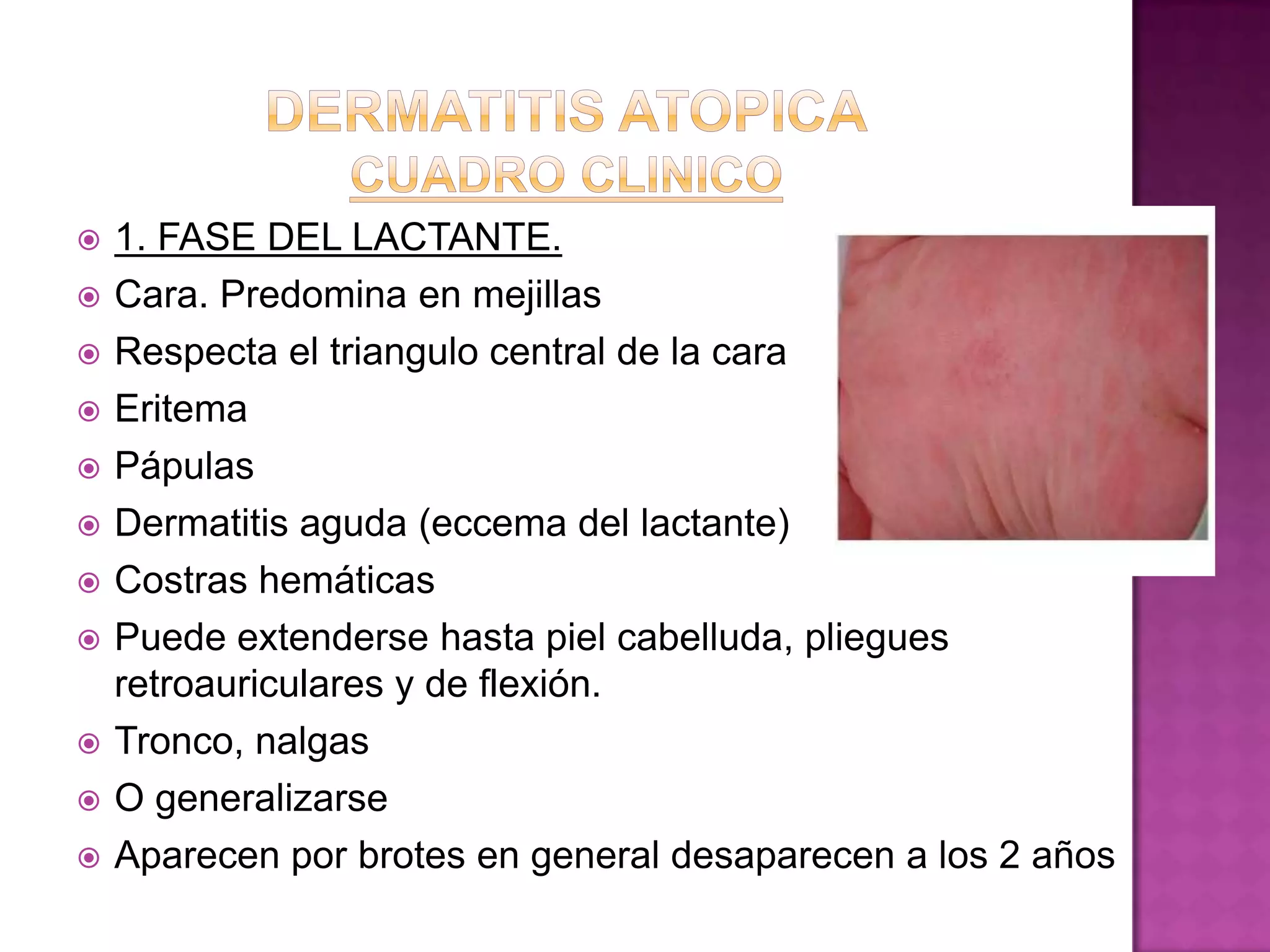 Dermatitis atopica presentacion | PPTX