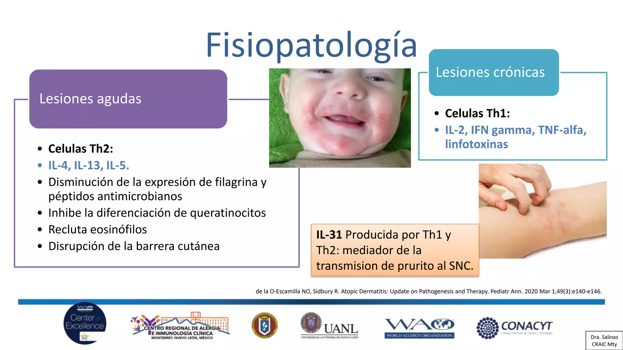 Dermatitis atópica sesión clínica | PDF