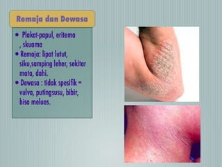 Dermatitis atopik | PPTX