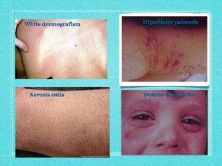 Dermatitis atopik | PPTX