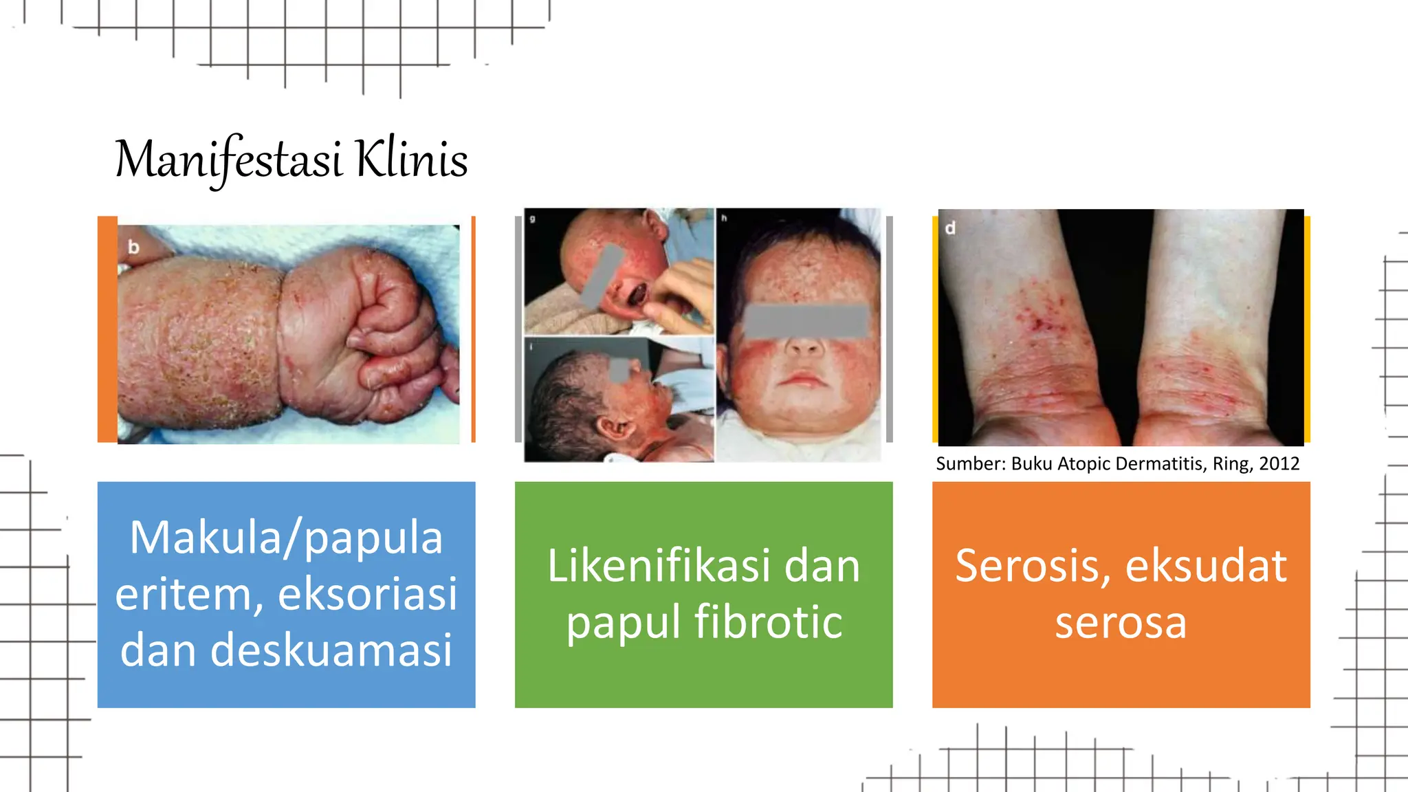 Dermatitis Atopik Dermatitis Atopik Dermatitis Atopik | PPTX