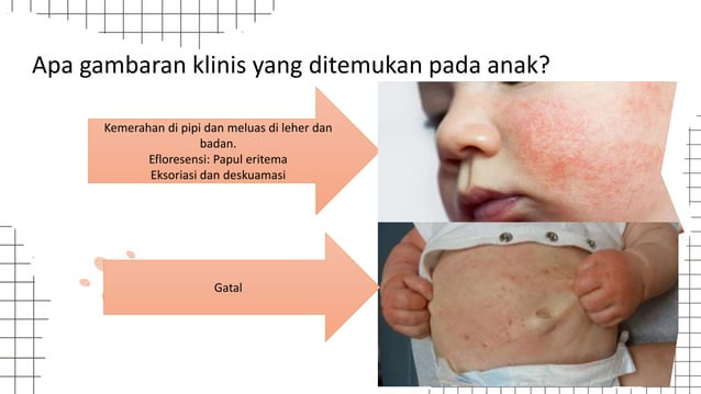 Dermatitis Atopik Dermatitis Atopik Dermatitis Atopik | PPTX