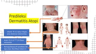 Dermatitis Atopik Dermatitis Atopik Dermatitis Atopik | PPTX