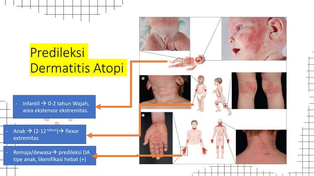 Dermatitis Atopik Dermatitis Atopik Dermatitis Atopik | PPTX