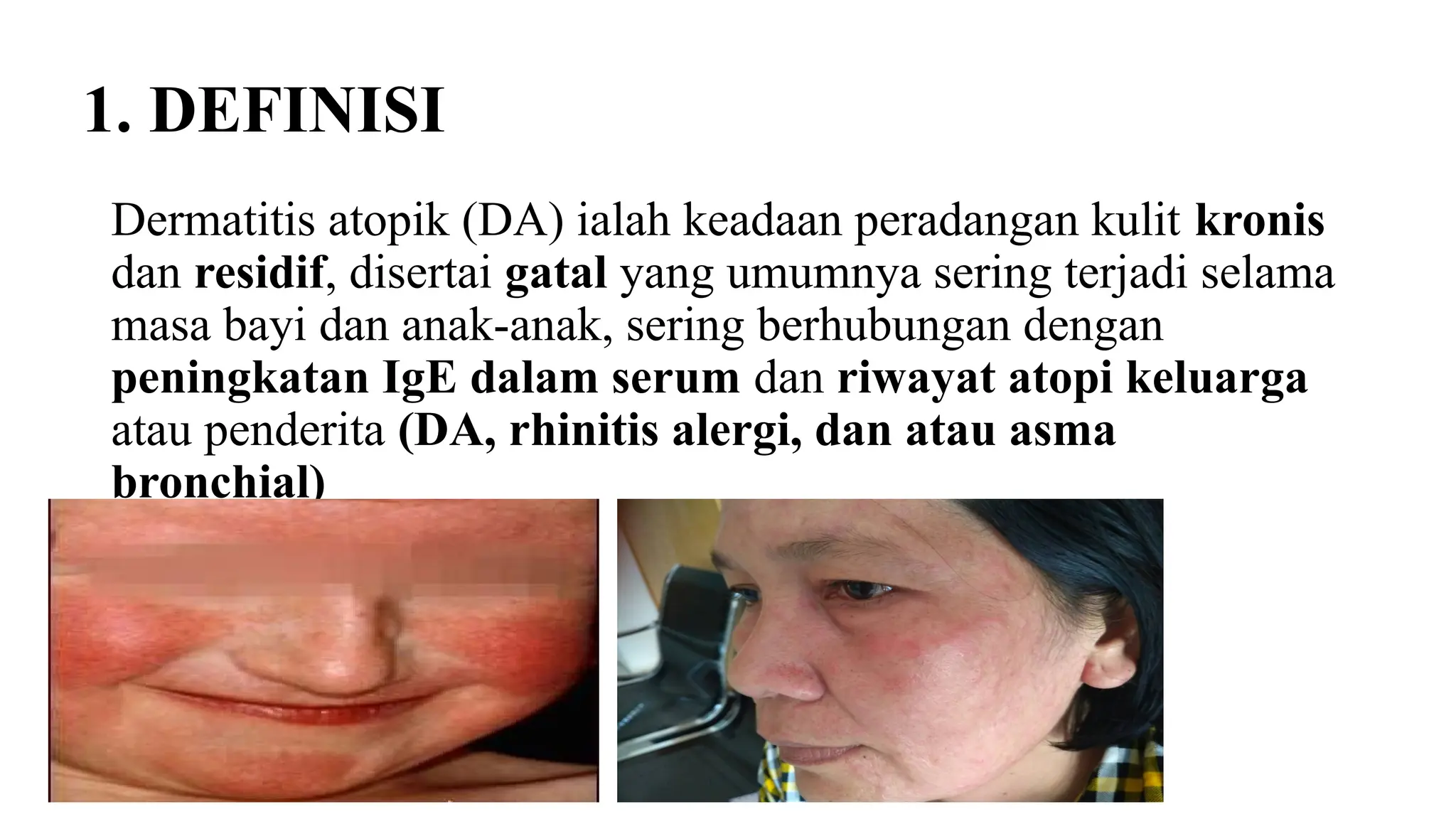 Materi tentang Dermatitis Atopik baru.pptx