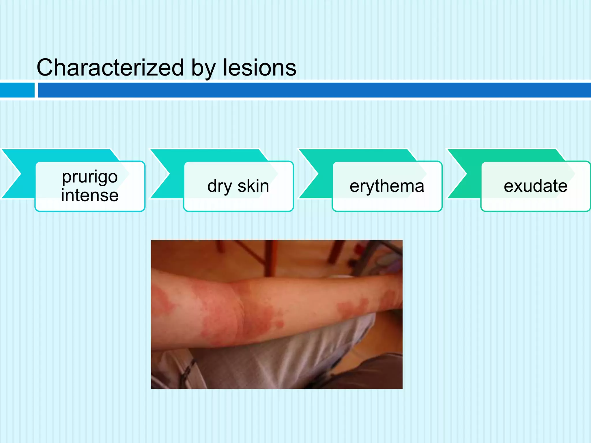 Dermatitis atópica | PPTX