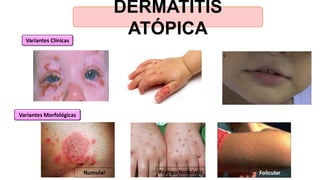 DERMATITIS ATÓPICA PEDIATRICA.pptx