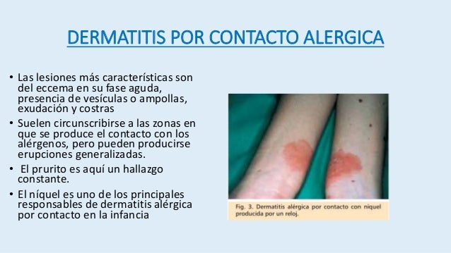 Dermatitis de contacto