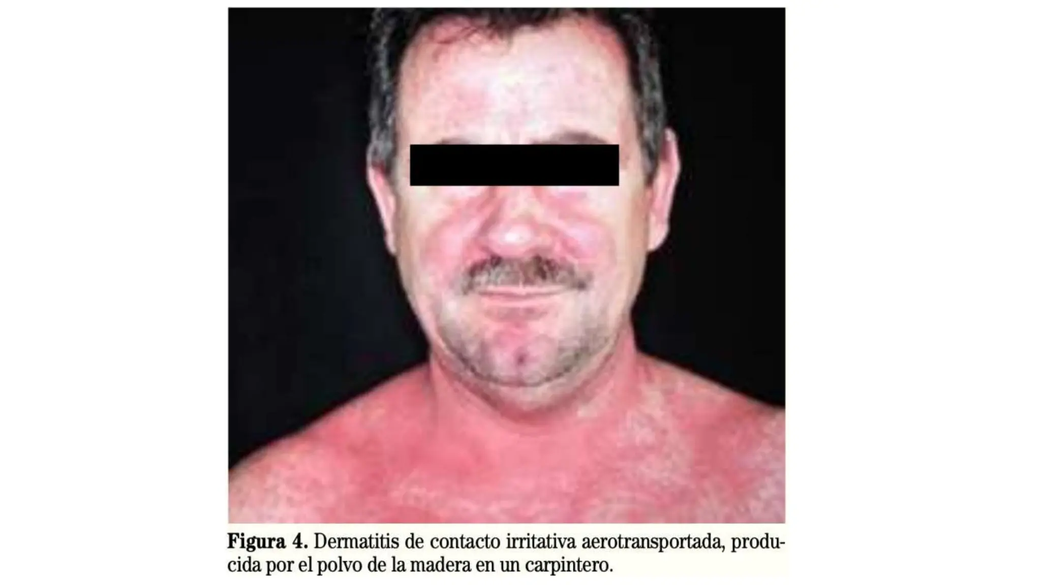 dermatitis de contacto dermatologia irritativa | PPTX