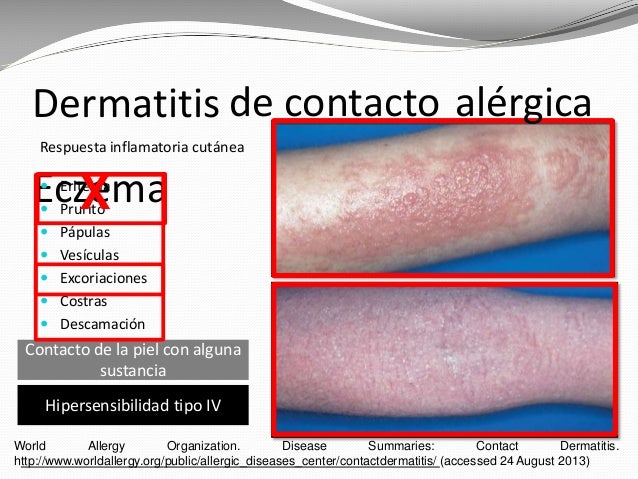 Dermatitis de contacto alérgica