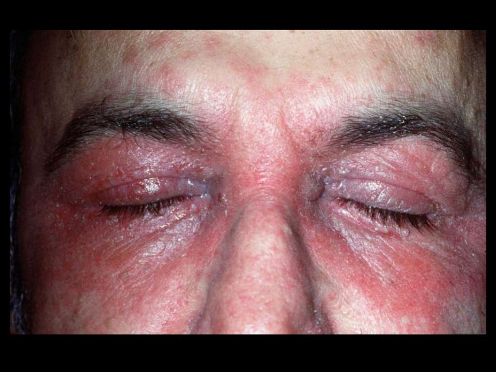 Dermatitis de contacto alérgica