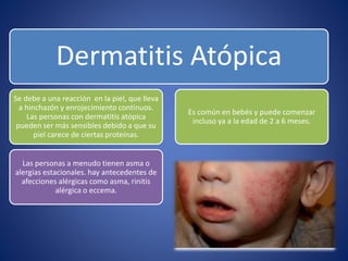 Dermatitis eccemotasas | PPTX