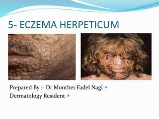 Dermatitis (eczema) | PPTX
