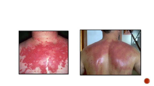 Dermatitis fotoalérgica | PPT