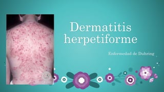Laboratorios Dermatitis Herpetiforme