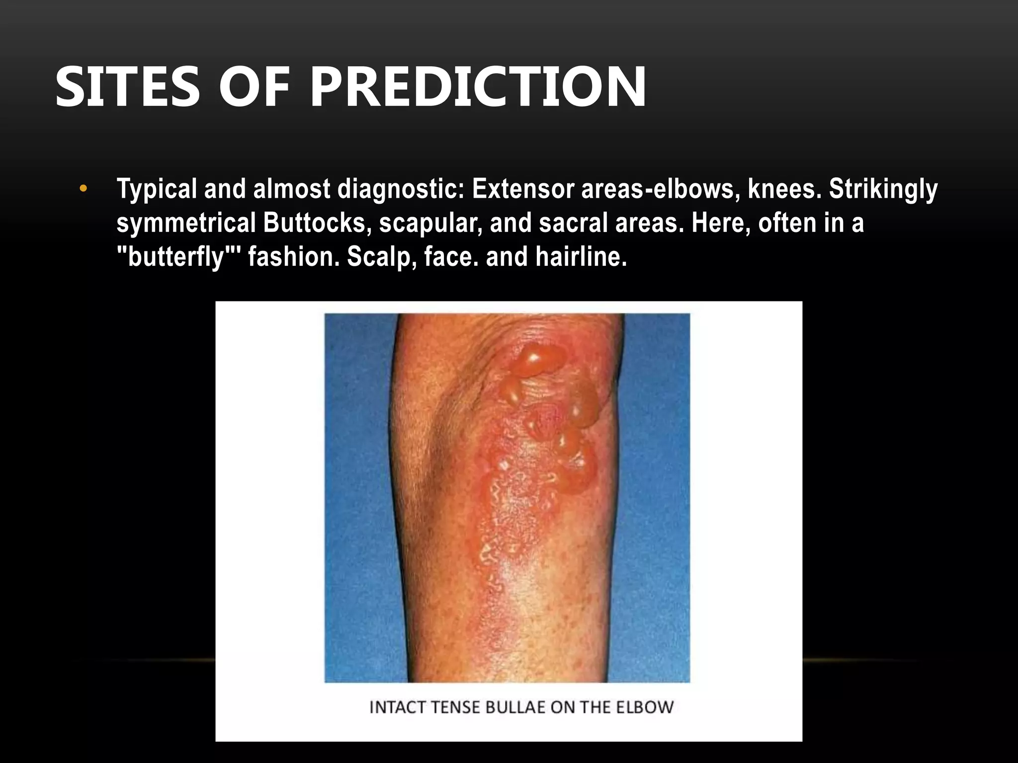 Dermatitis herpetiformis (dh) | PPTX