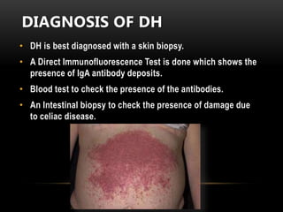 Dermatitis herpetiformis (dh) | PPTX