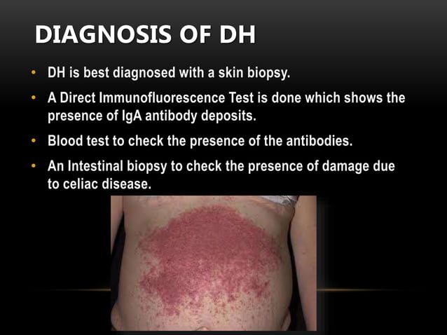 Dermatitis herpetiformis (dh) | PPTX