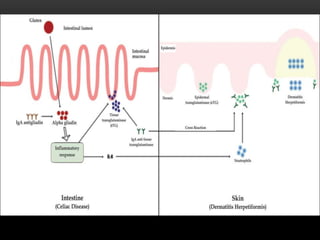 Dermatitis herpetiformis (dh) | PPTX