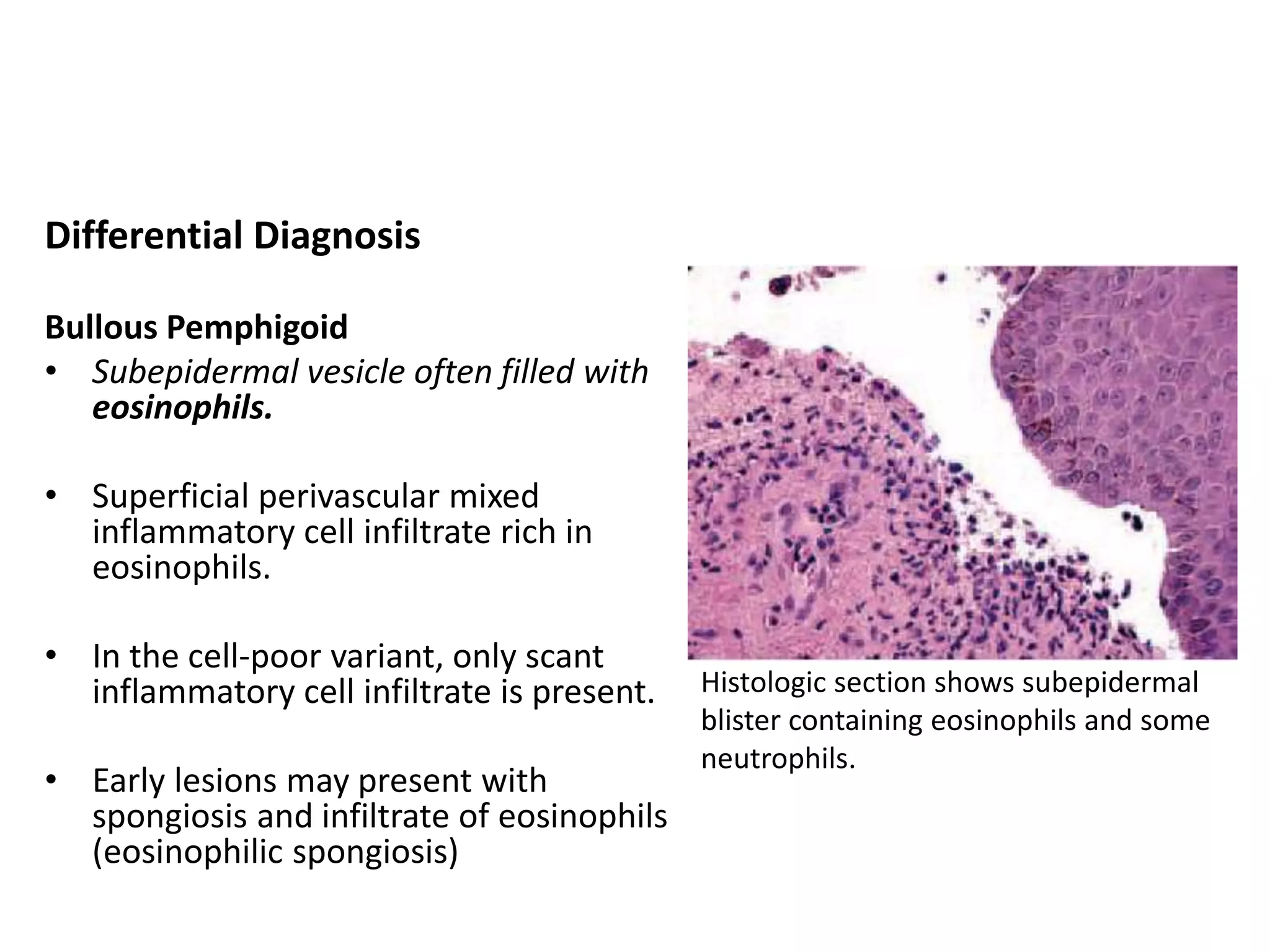 Dermatitis herpetiformis | PPTX