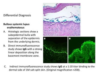 Dermatitis herpetiformis | PPTX