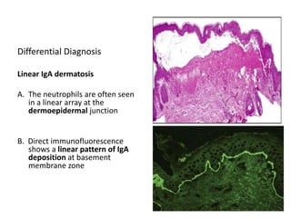 Dermatitis herpetiformis | PPTX