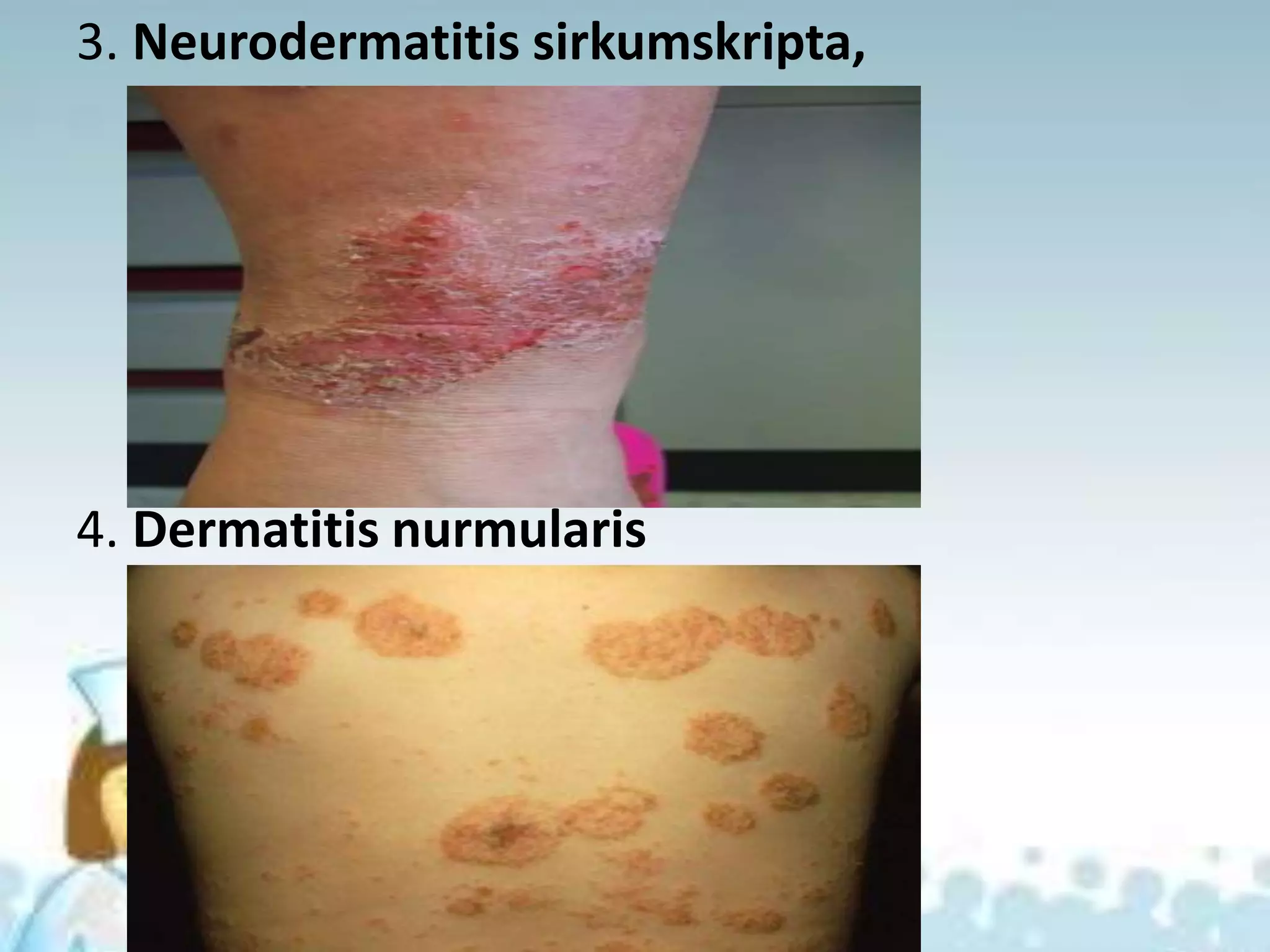 Dermatitis | PPTX