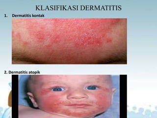Dermatitis | PPTX
