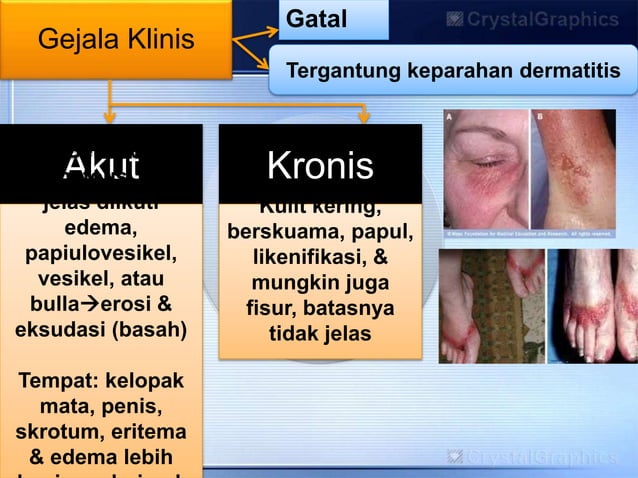 Dermatitis kontak alergi | PPTX