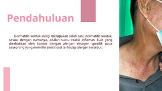 Dermatitis Kontak Alergi ec semir rambut | PPTX