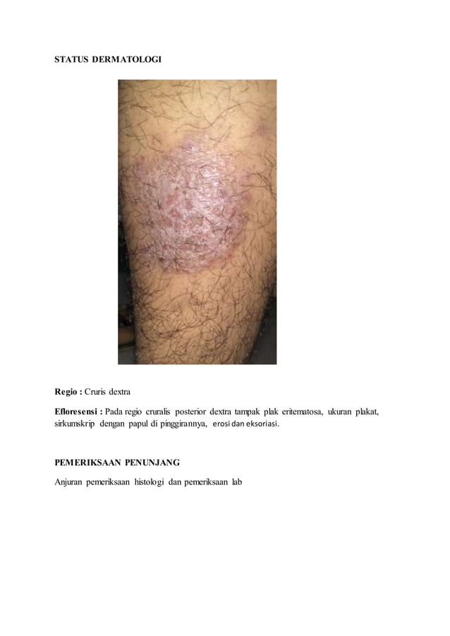 Dermatitis numularis | DOCX