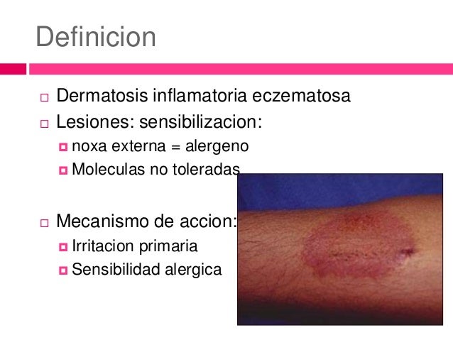 Qu Es La Dermatitis De Contacto Sntomas Causas Y