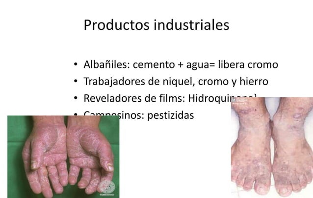 Dermatitis por contacto | PPT