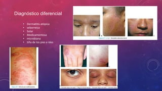 Dermatitis por contacto | PPTX