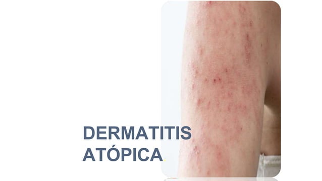 DERMATITIS POR CONTACTO.pptx