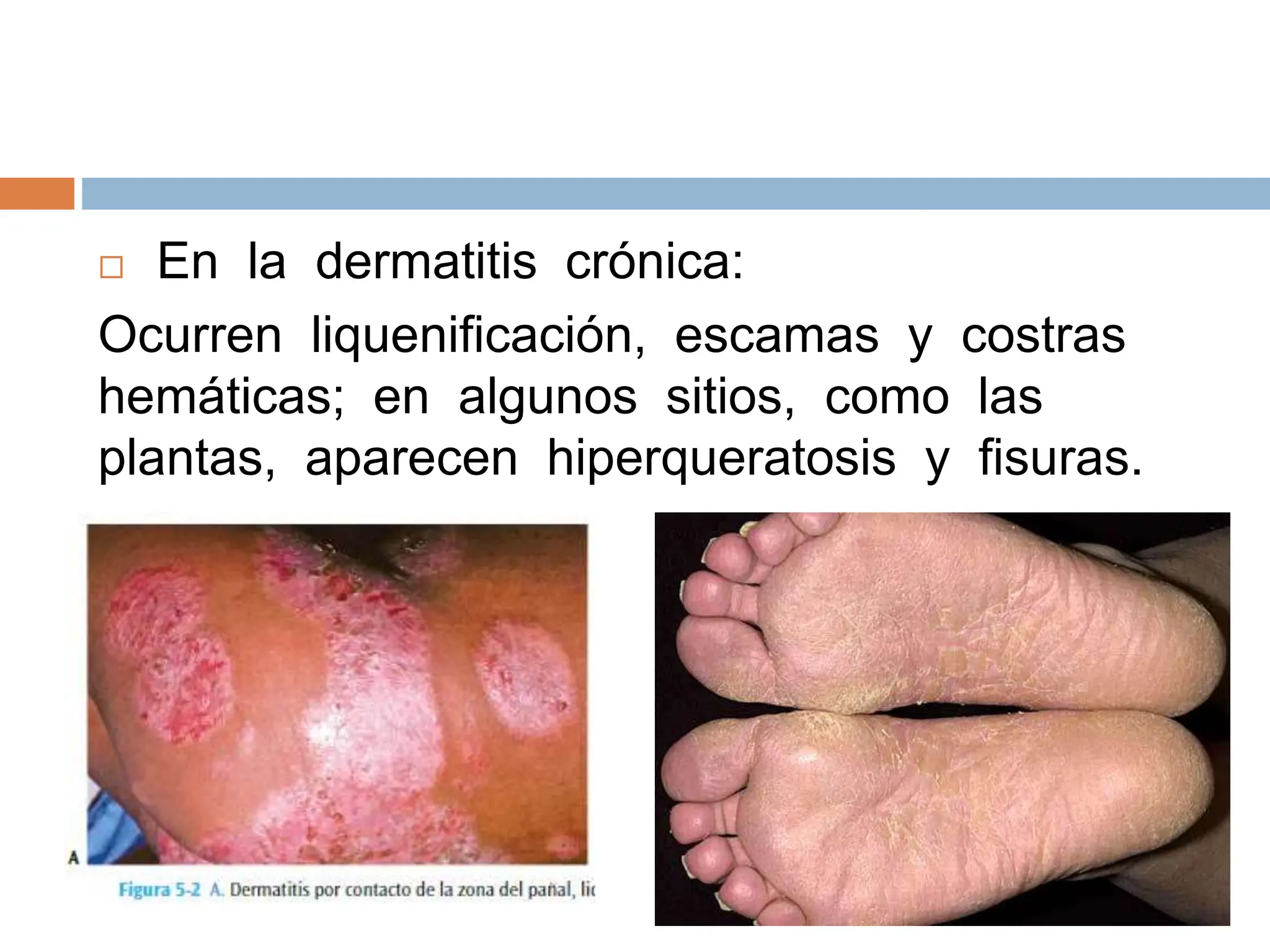DERMATITIS POR CONTACTO para estudiantes de universidad | PPTX | Skin ...