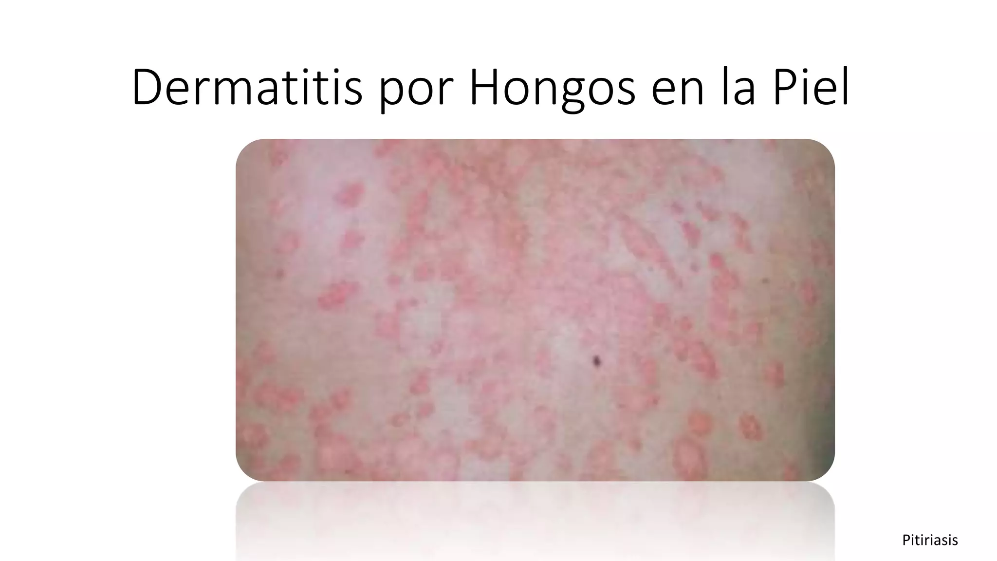 Dermatitis por hongos en la piel | PPTX