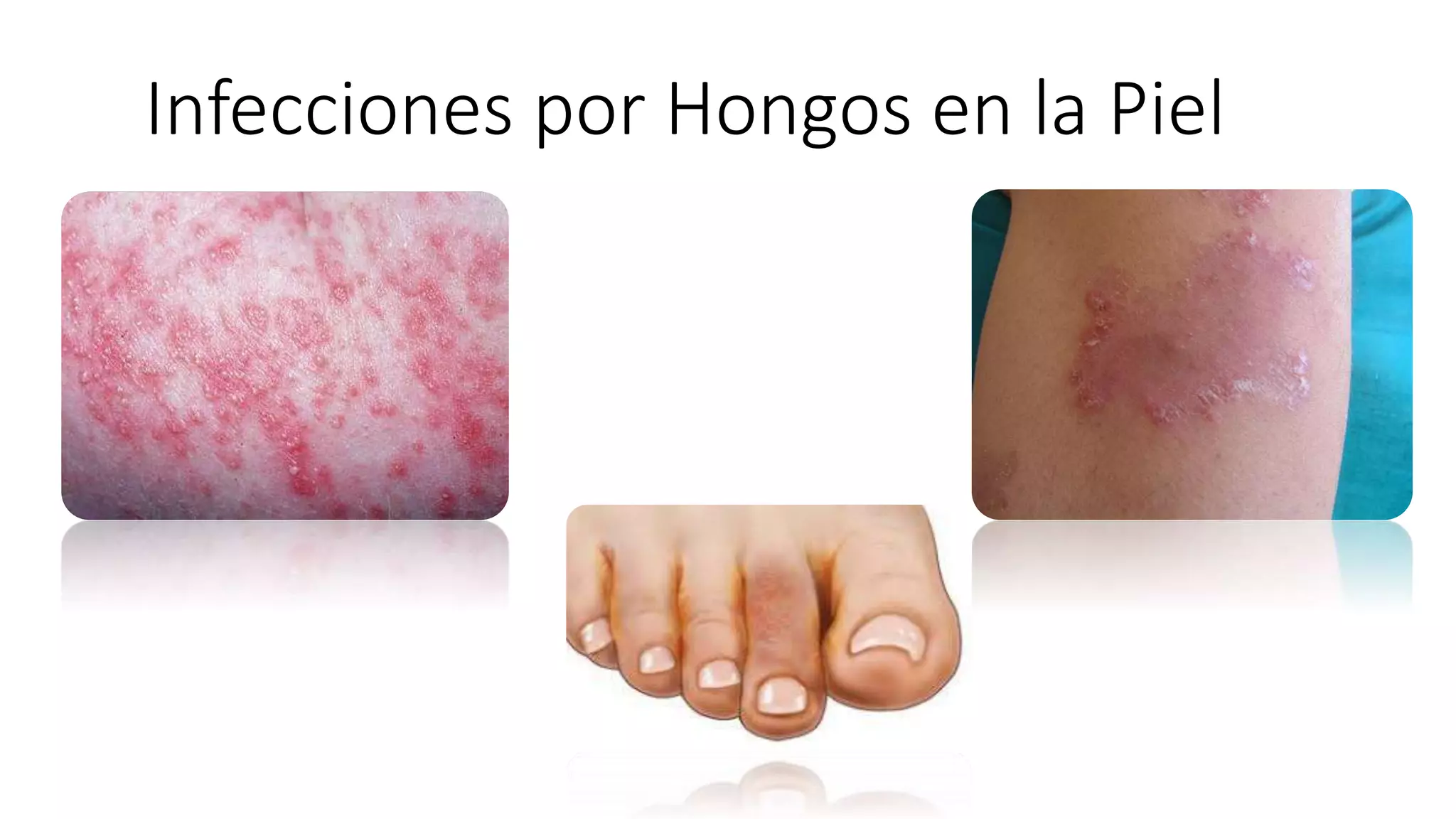 Dermatitis por hongos en la piel | PPTX