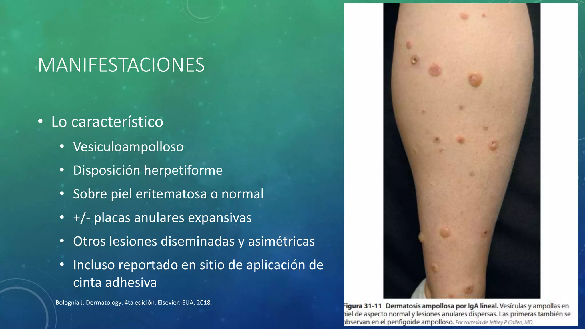 Dermatitis por IgA lineal