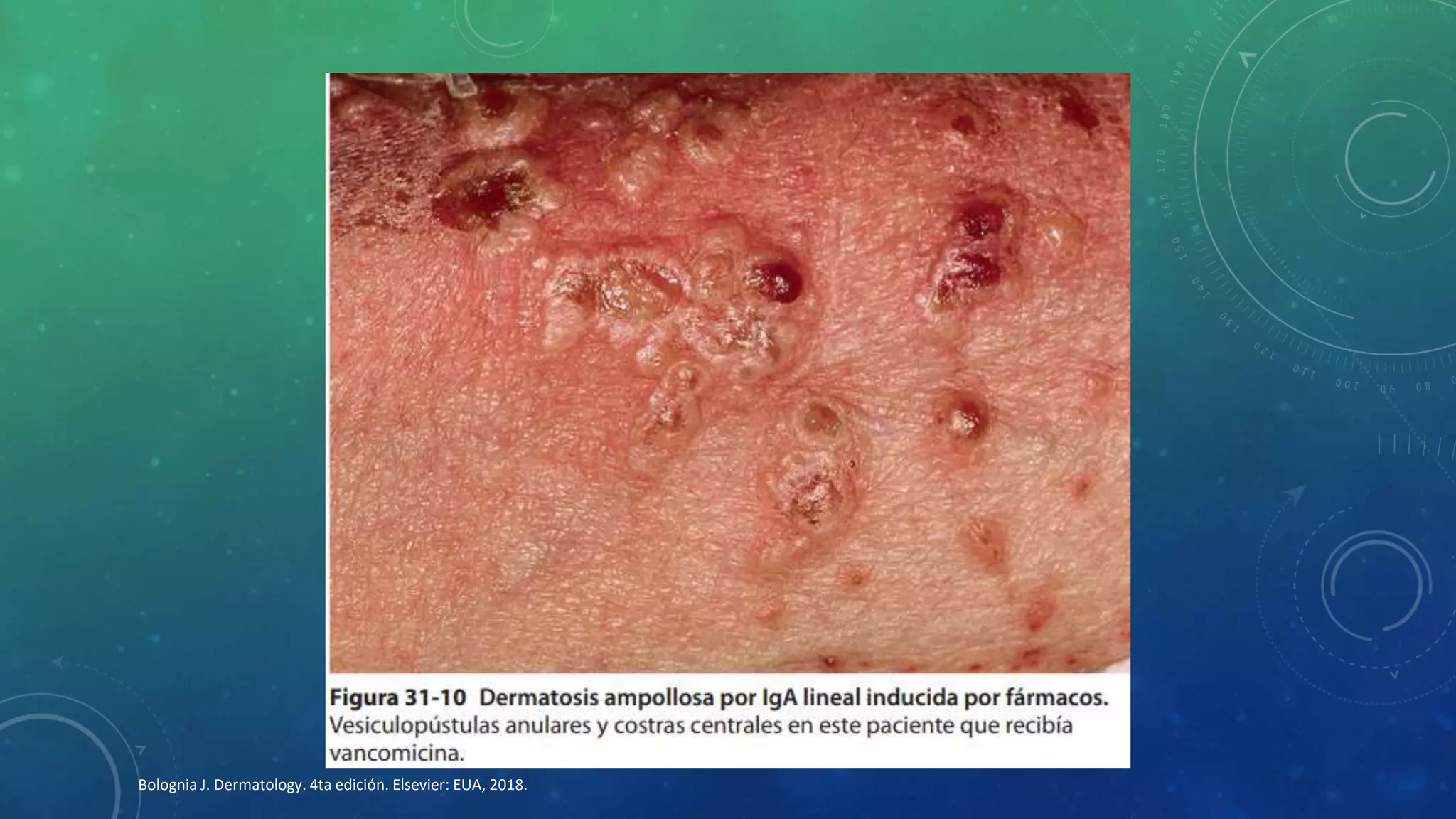 Dermatitis por IgA lineal