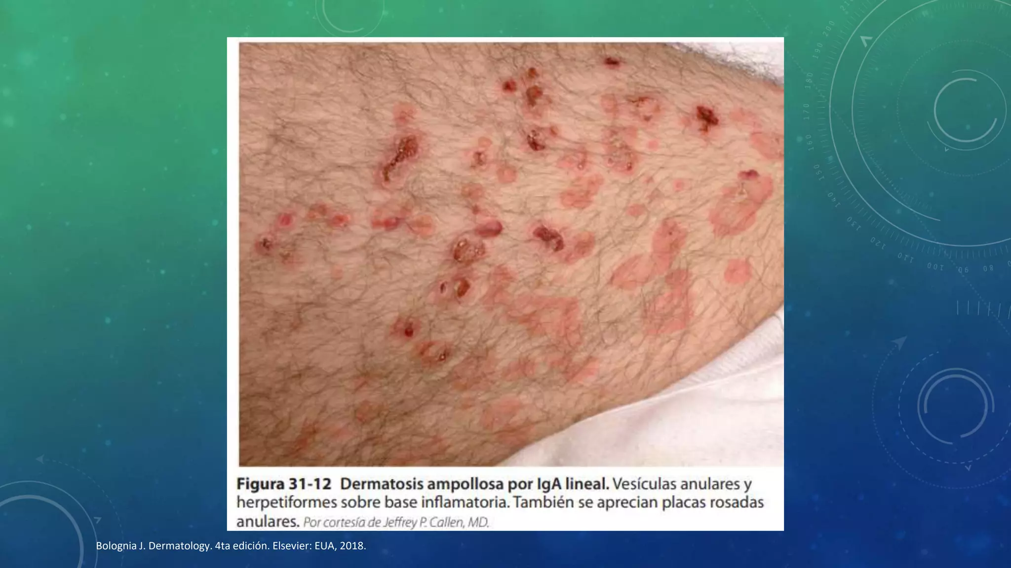 Dermatitis por IgA lineal