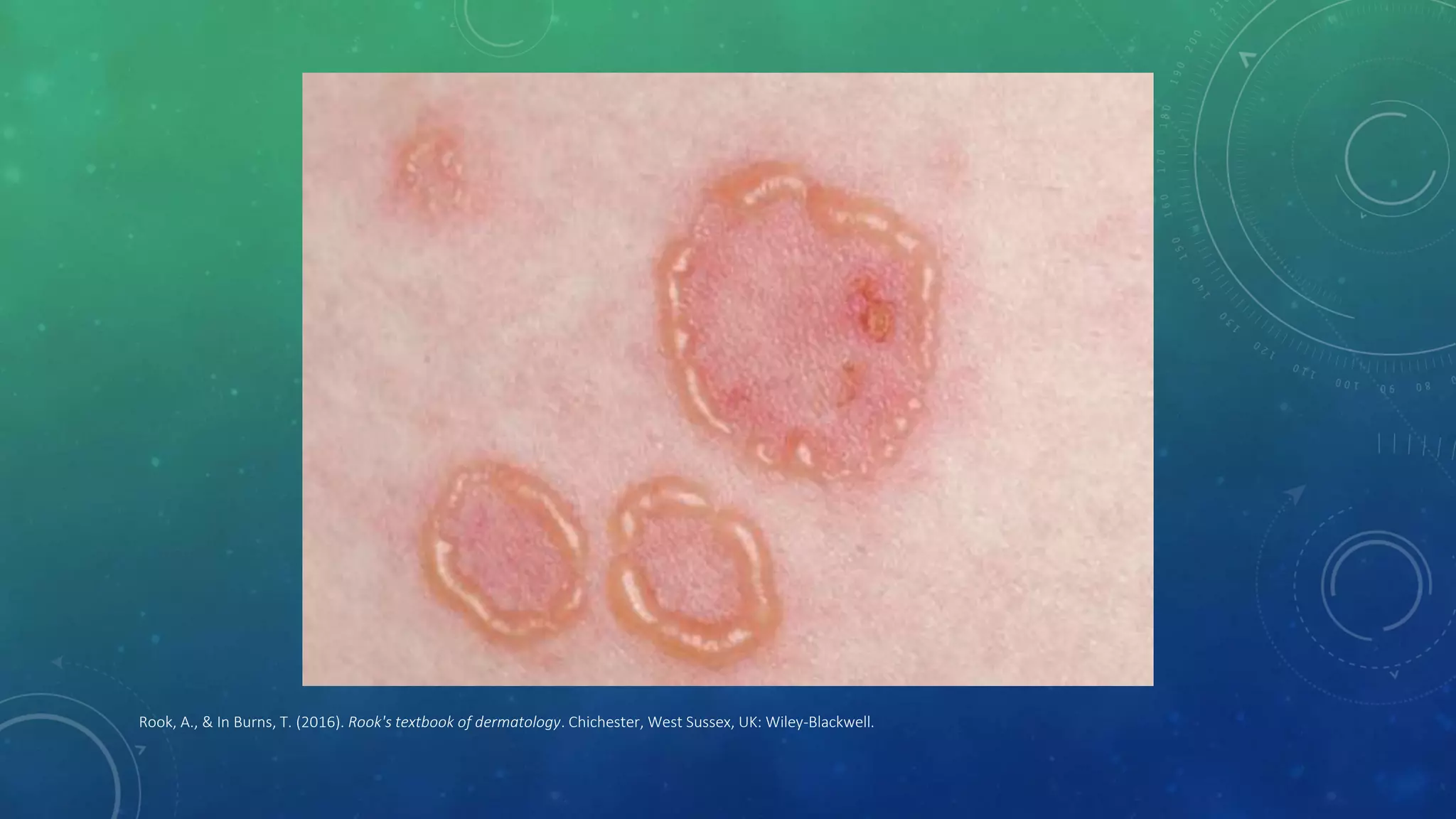 Dermatitis por IgA lineal