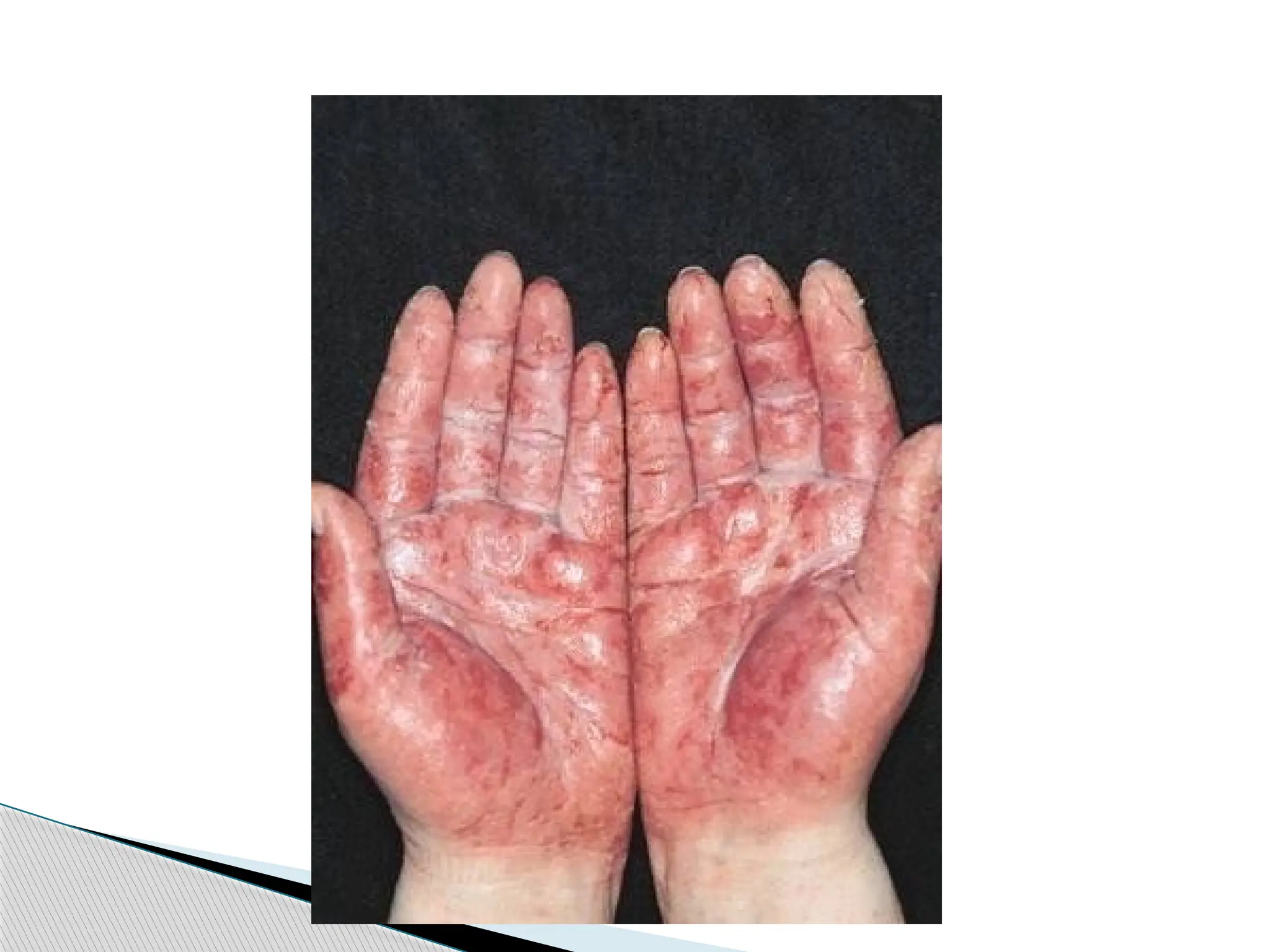 Dermatitis Power Point Presentation Pptx