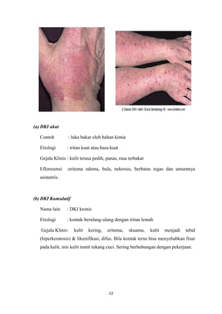 Dermatitis seboroik | DOCX
