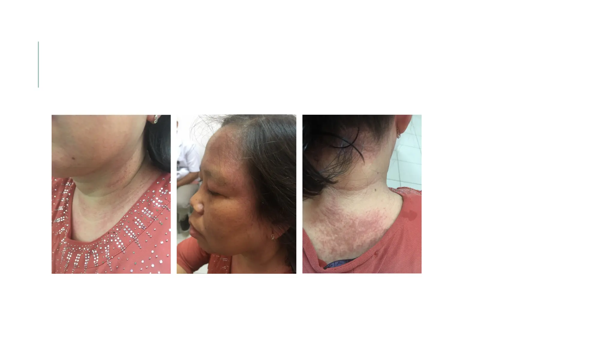 dermatitis seboroik punya icaerikaricarica | PPTX