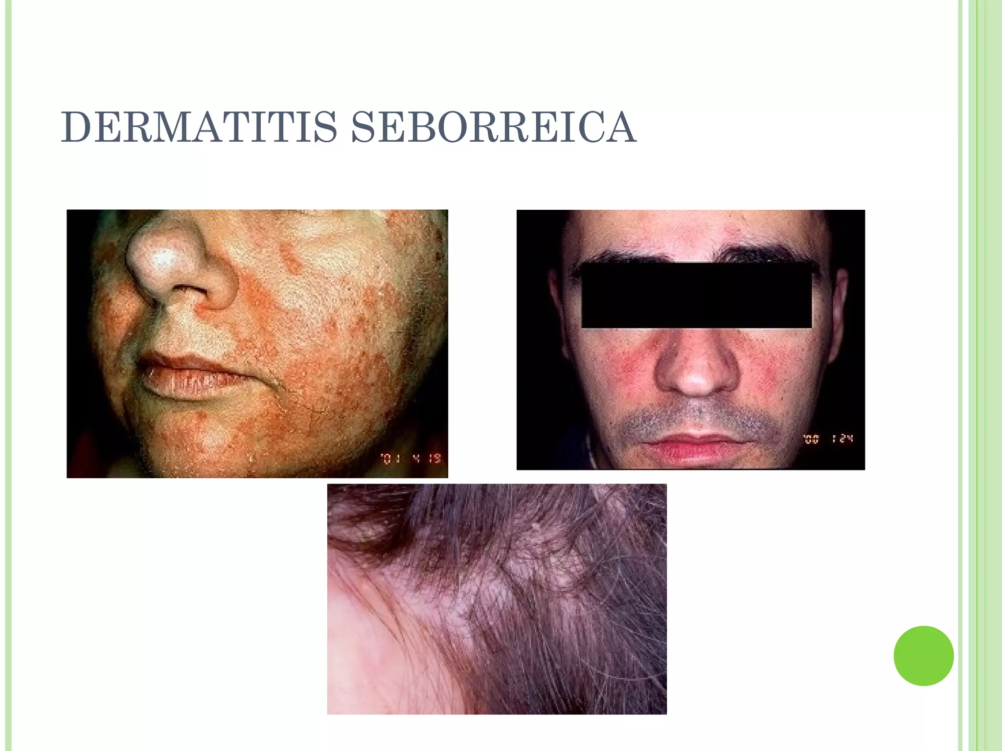 Dermatitis seborreica | PPT