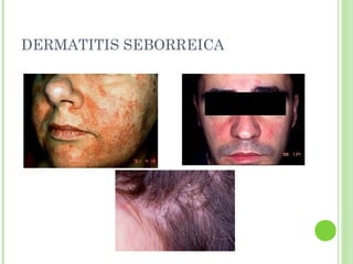 Dermatitis seborreica | PPT