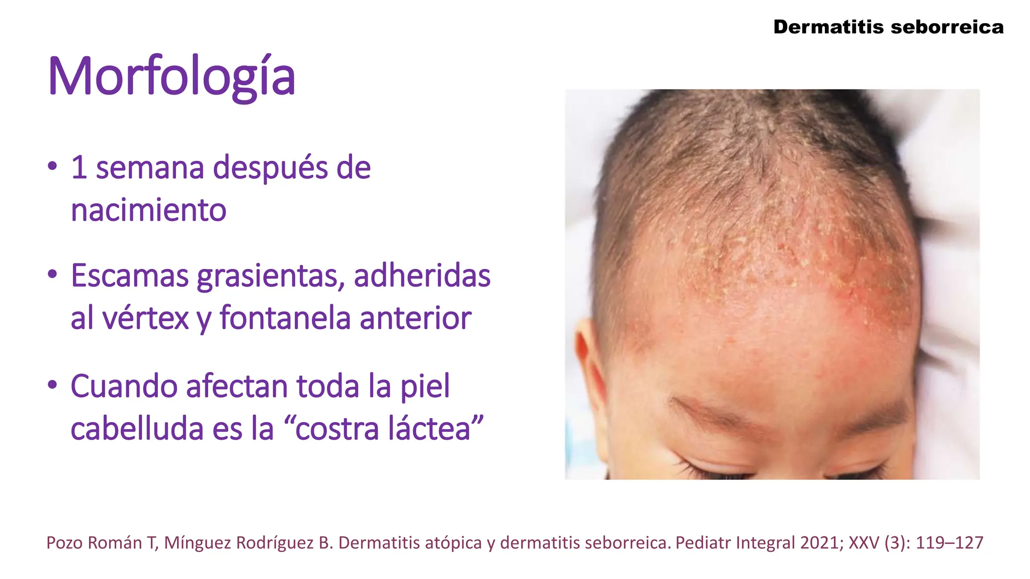 Dermatitis Seborreica en Neonatos | PPT