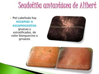 Dermatitis seborreica pp | PPTX